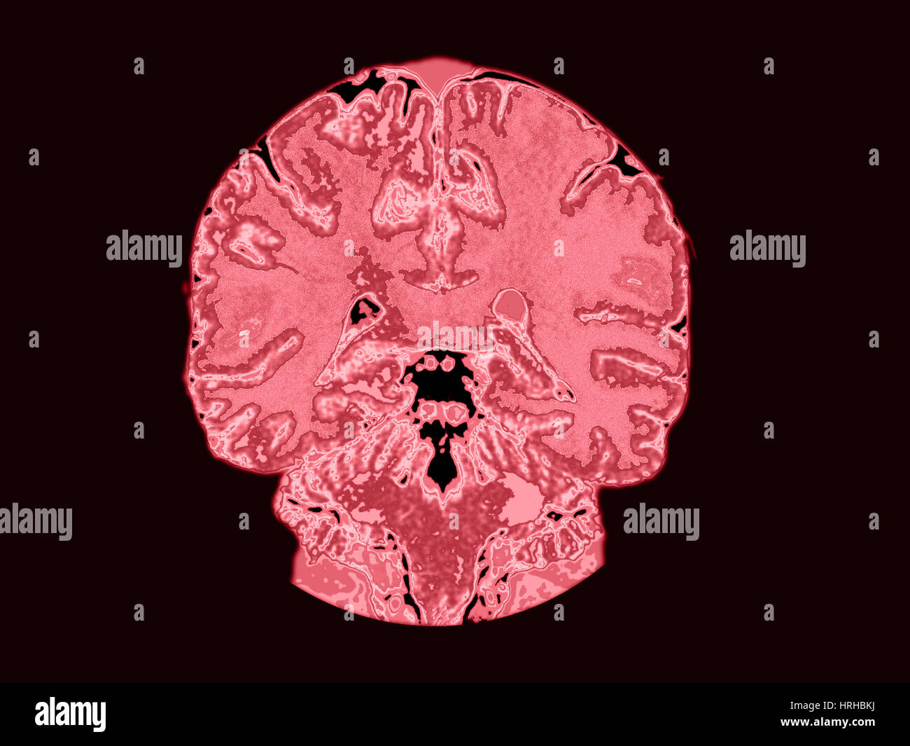 Coronal View MRI of Normal Brain Stock Photo - Alamy