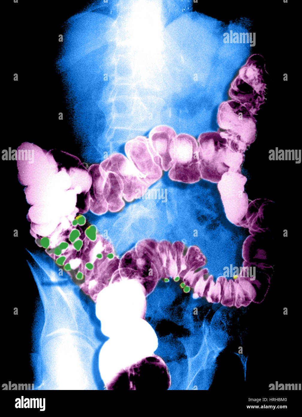 Barium Enema Showing Diverticulosis Stock Photo - Alamy