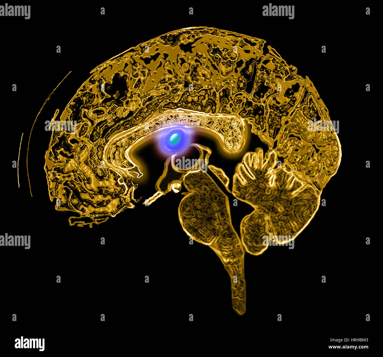 Colloid cysts hi-res stock photography and images - Alamy