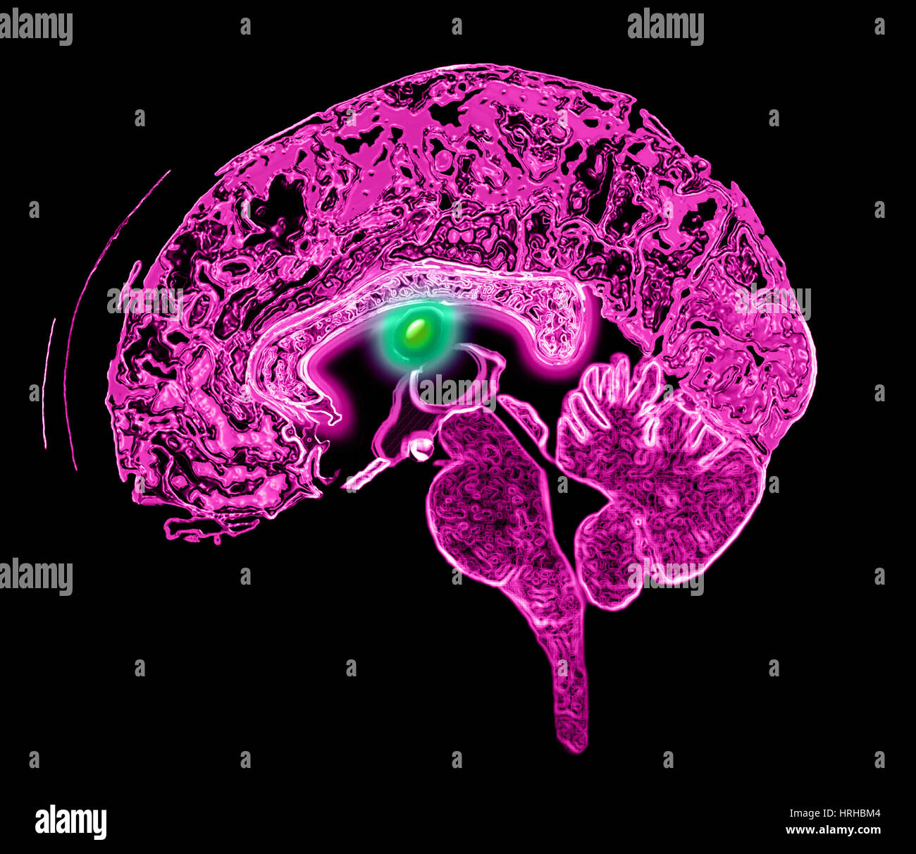 Benign cyst hi-res stock photography and images - Alamy