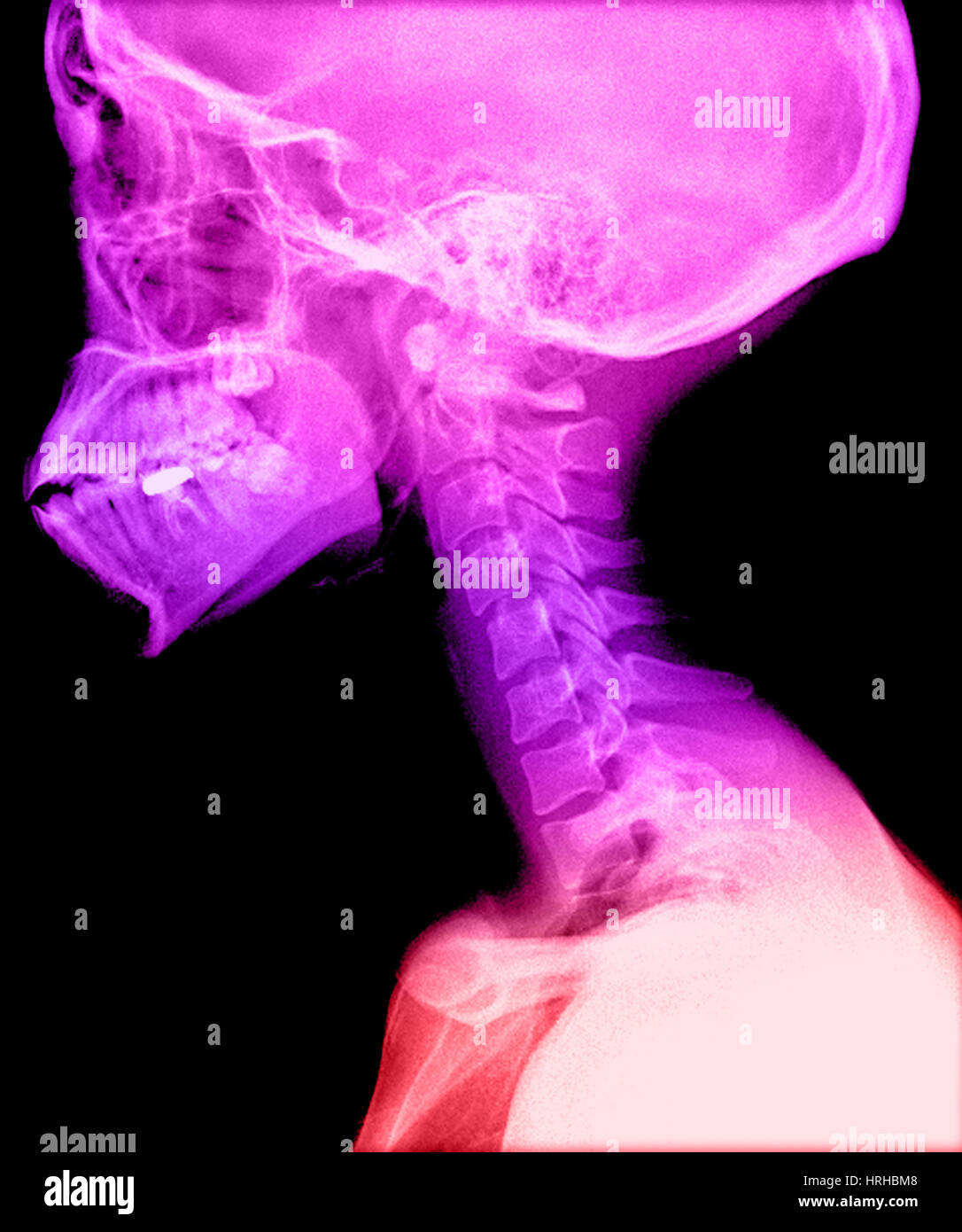 Lateral x ray cervical spine neck hi-res stock photography and images ...