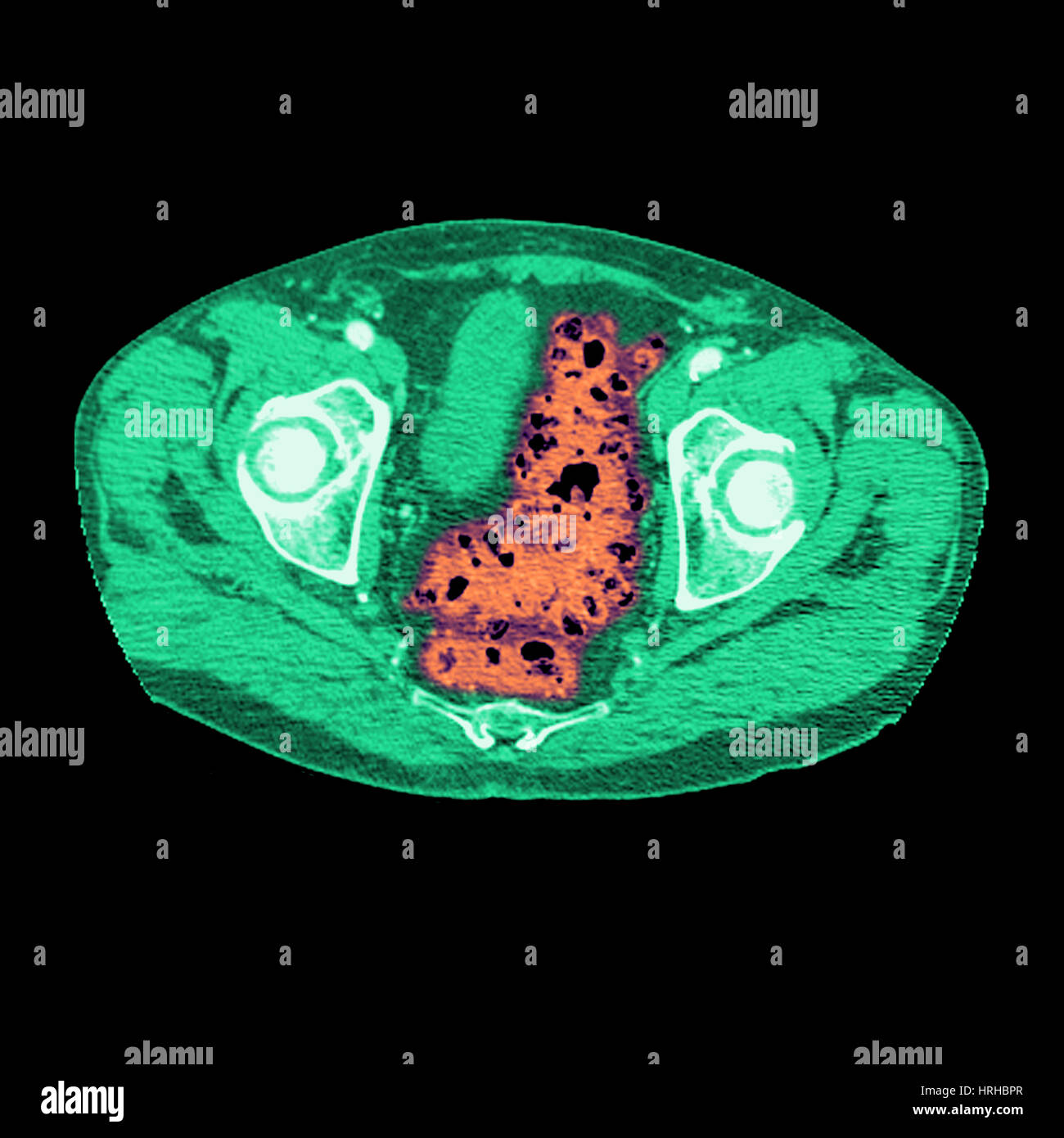Diverticulosis of colon hi-res stock photography and images - Alamy