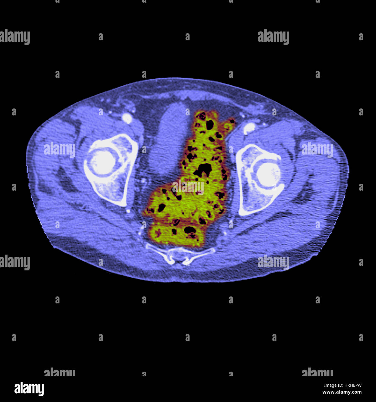 Diverticulosis of colon hi-res stock photography and images - Alamy