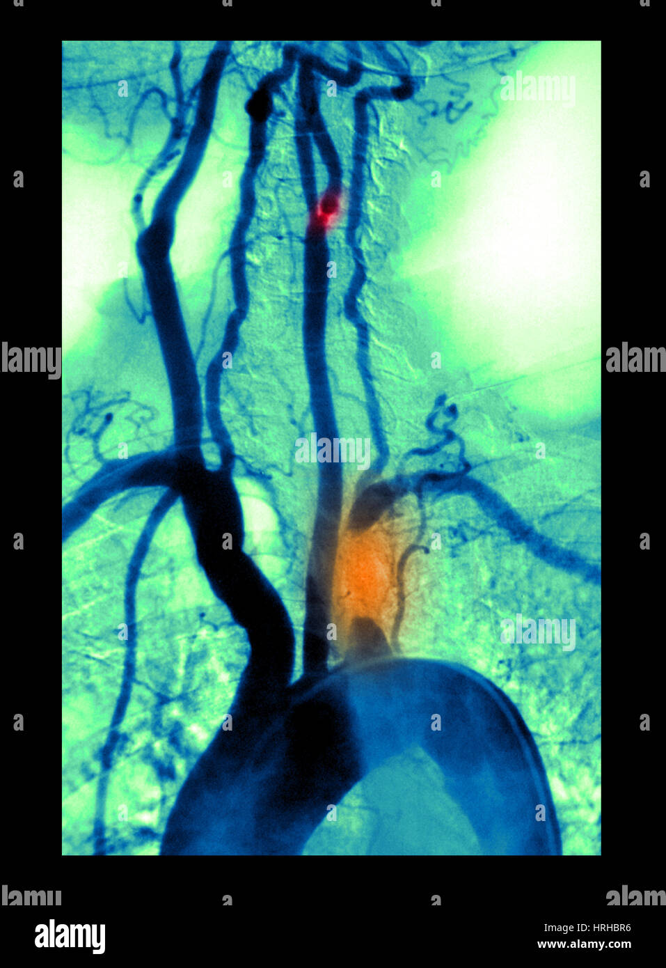 Aortic Arch Angiogram Stock Photo - Alamy