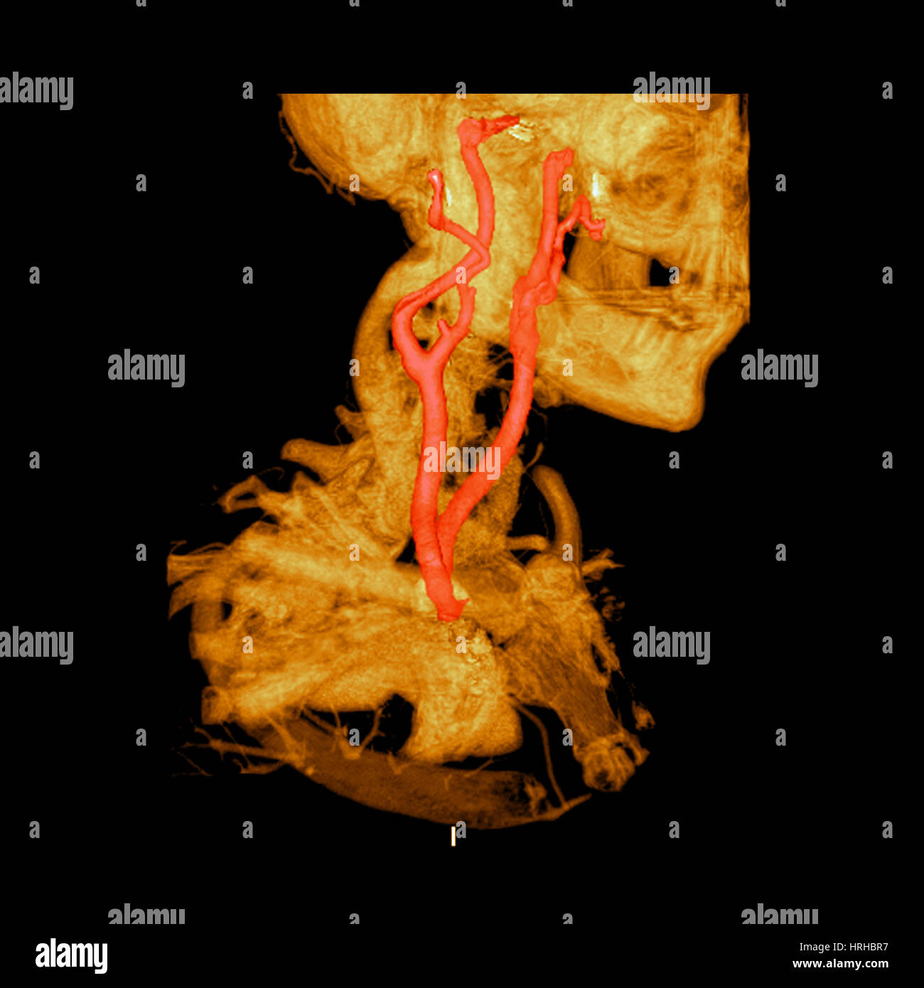 Arteries Angiogram Stock Photos & Arteries Angiogram Stock Images - Alamy