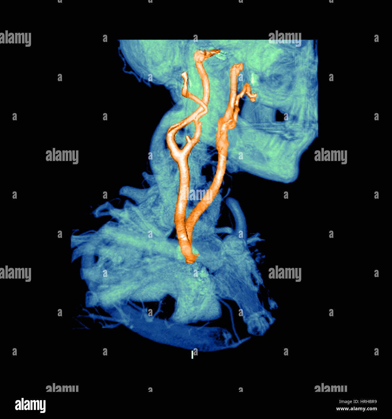 Carotid angiogram normal hi-res stock photography and images - Alamy