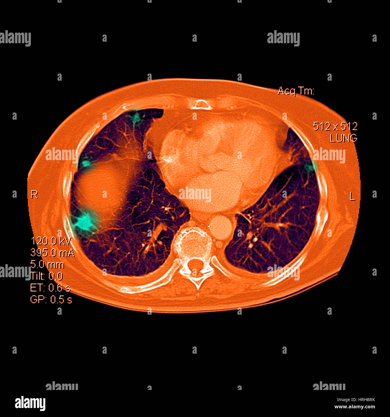 Metastatic lung cancer hi-res stock photography and images - Alamy