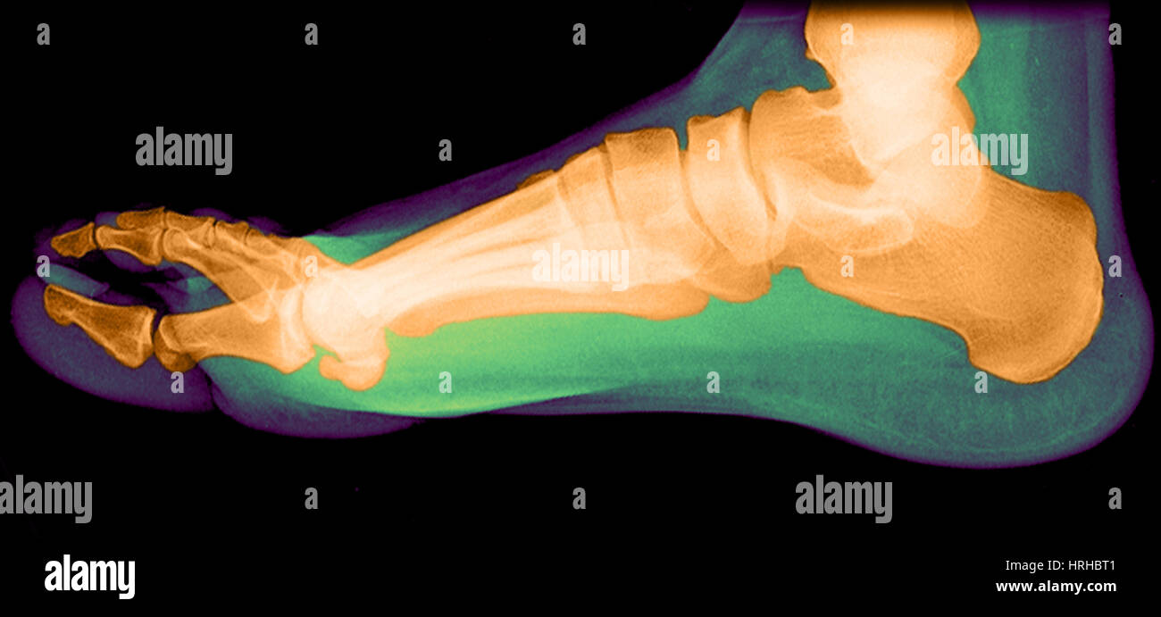 Distal tibia hi-res stock photography and images - Alamy