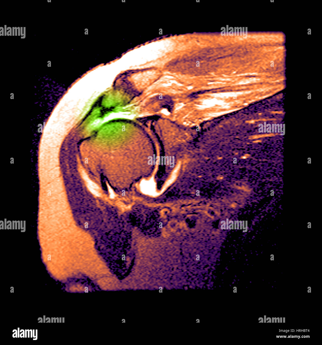 Rotator cuff tear hi-res stock photography and images - Alamy