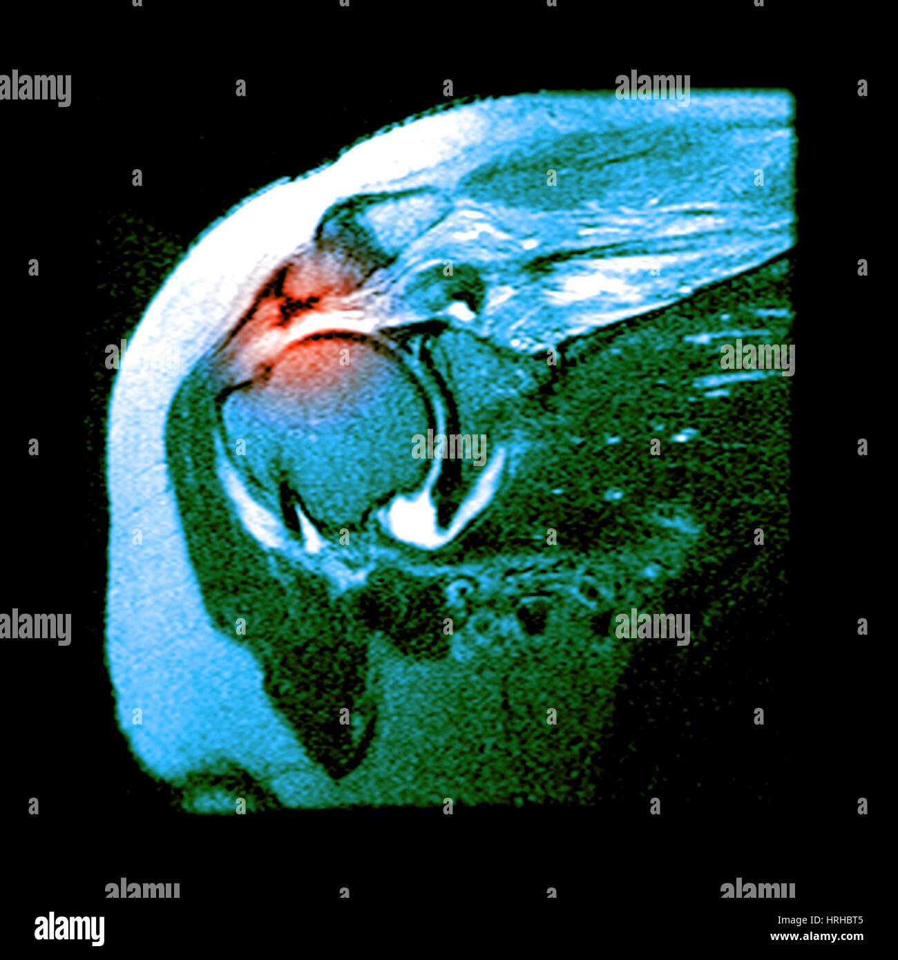 Rotator cuff injury hi-res stock photography and images - Alamy