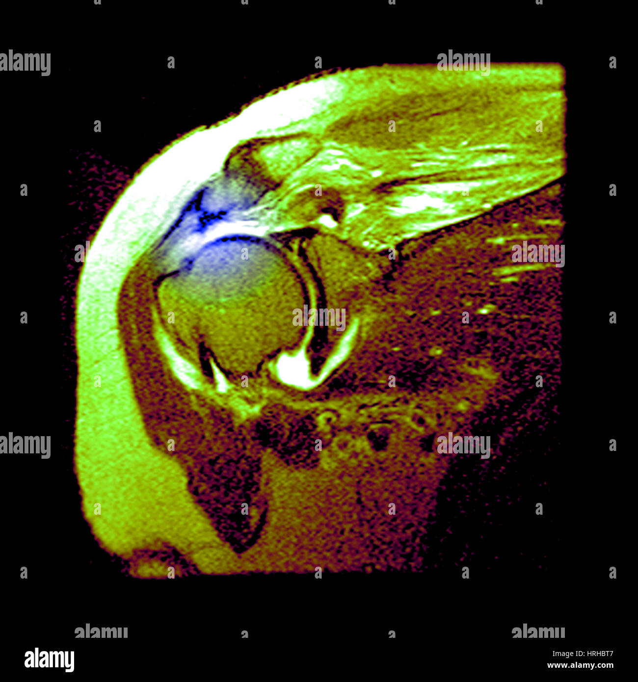 Rotator cuff tear Stock Photo - Alamy