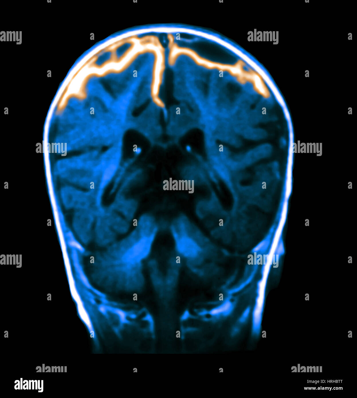Cerebral meningitis hi-res stock photography and images - Alamy