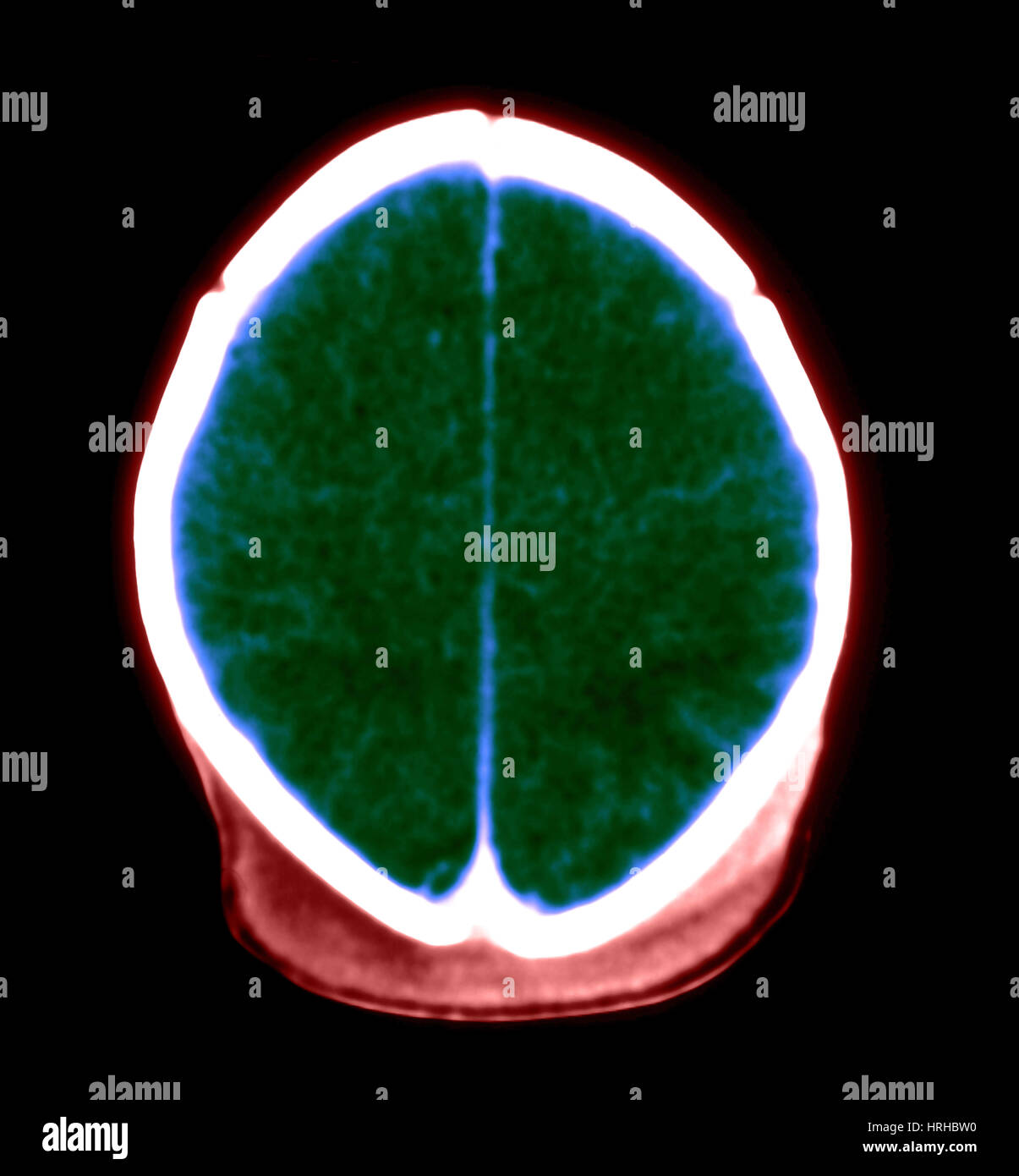 Ct scan brain damage hi-res stock photography and images - Alamy