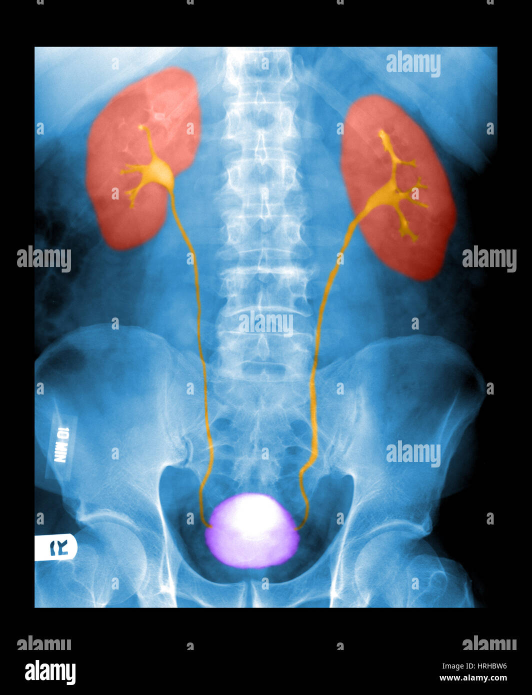 Normal urinary system ivp hi-res stock photography and images - Alamy