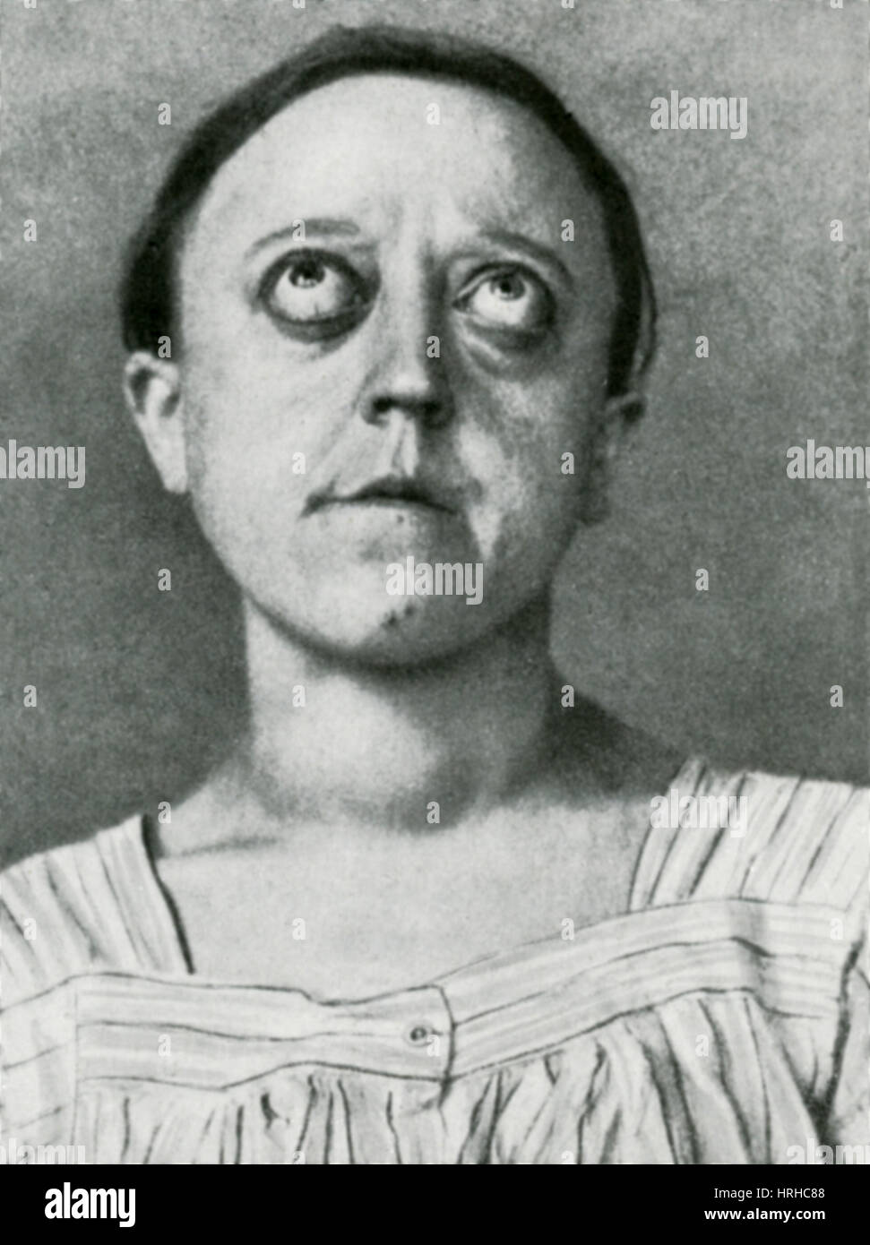 Basedow's graves' disease hi-res stock photography and images - Alamy