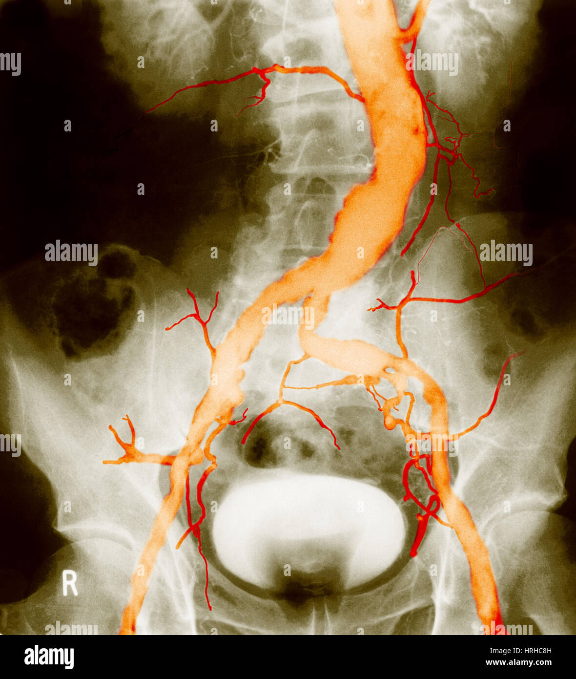 Atheroma in Aorta and Iliac Arteries Stock Photo - Alamy