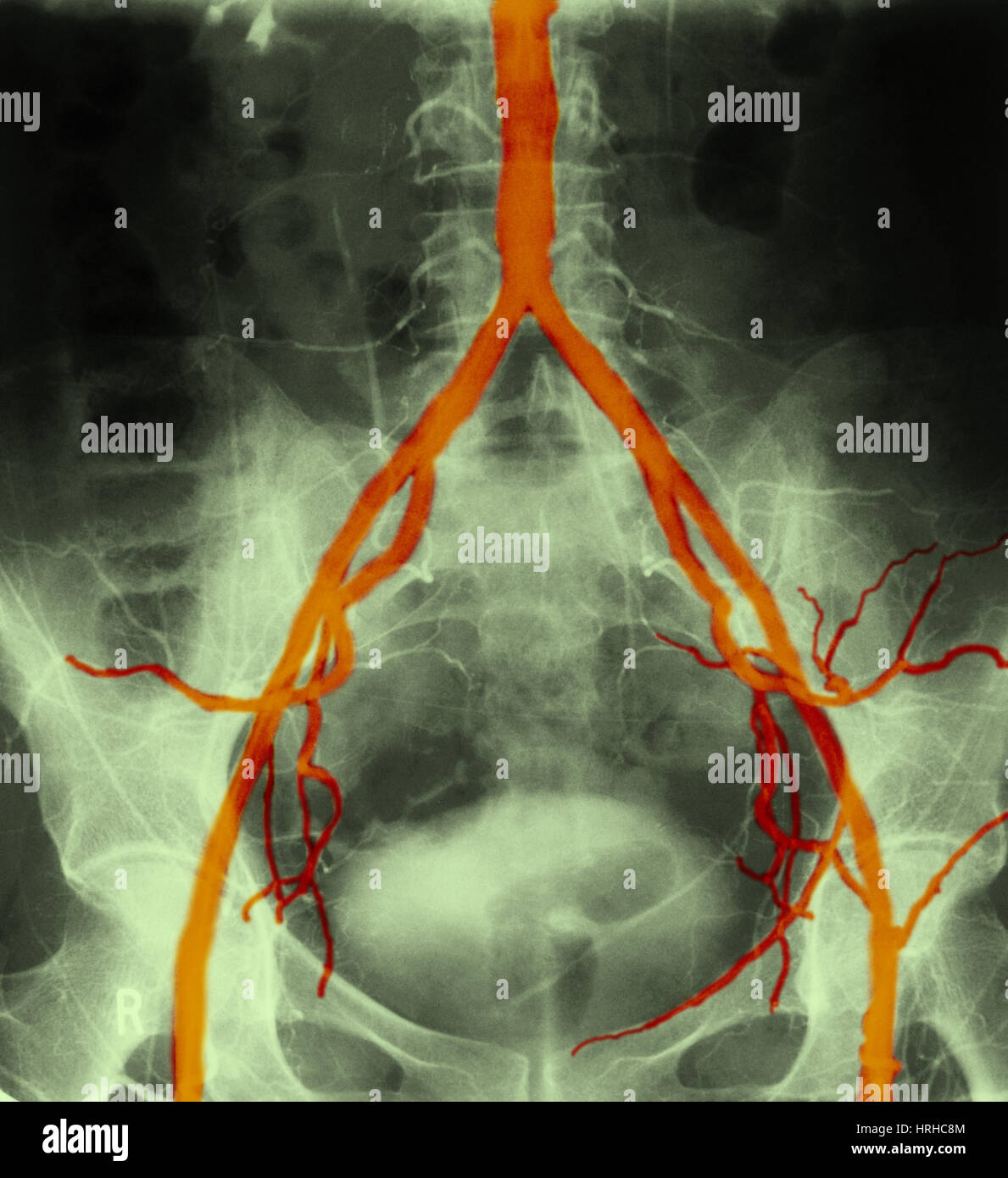 Normal iliac arteries hi-res stock photography and images - Alamy