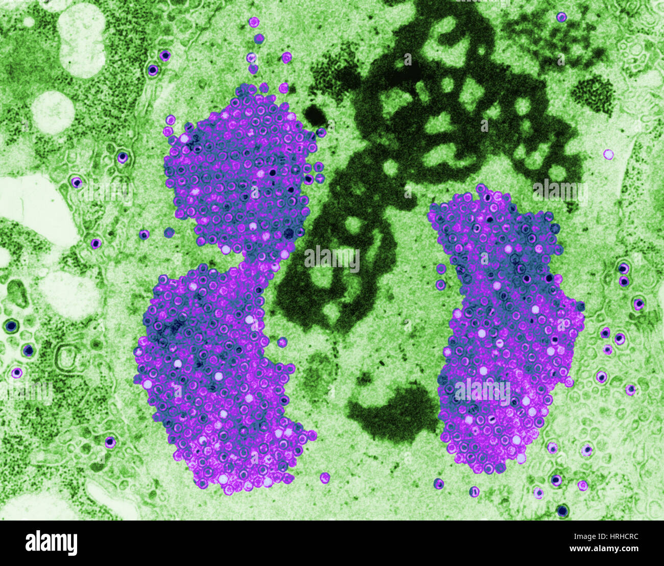 Herpes Simplex Virus Stock Photo - Alamy