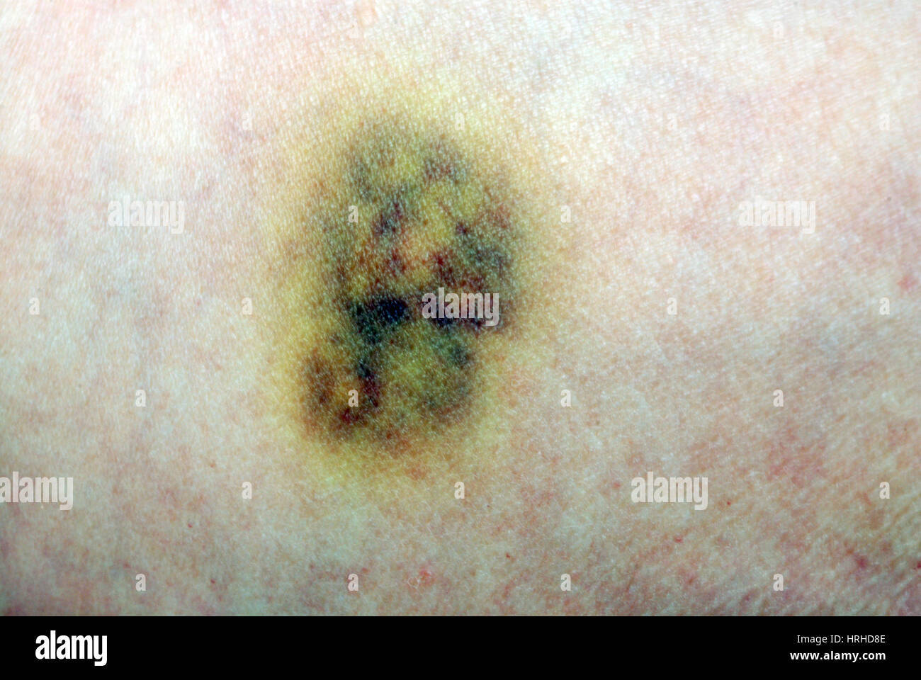 Skin contusion hi-res stock photography and images - Alamy