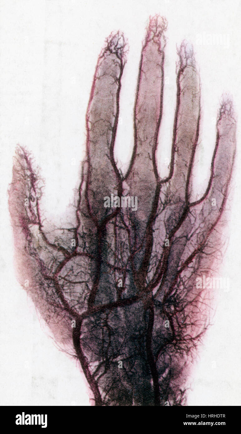 X-ray of Blood Vessels Stock Photo - Alamy