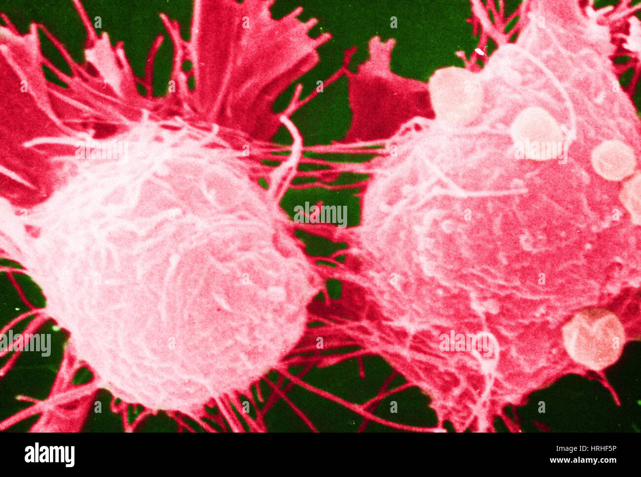 SEM of Neuroblastoma Stock Photo - Alamy