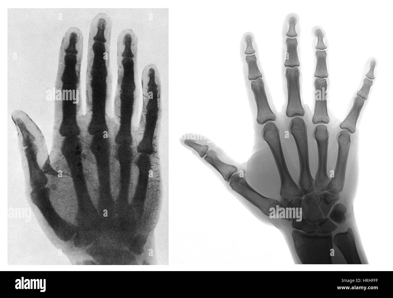 X ray normal hand hi-res stock photography and images - Alamy