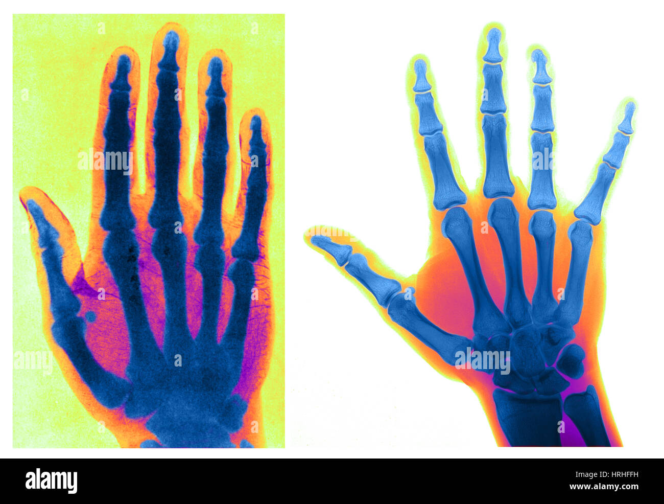 X ray normal hand hi-res stock photography and images - Alamy