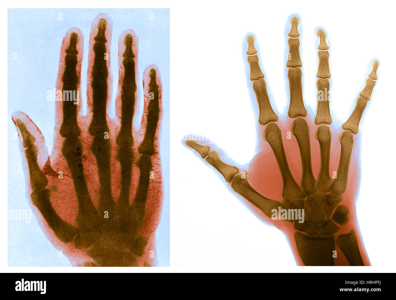 X ray normal hand hi-res stock photography and images - Alamy