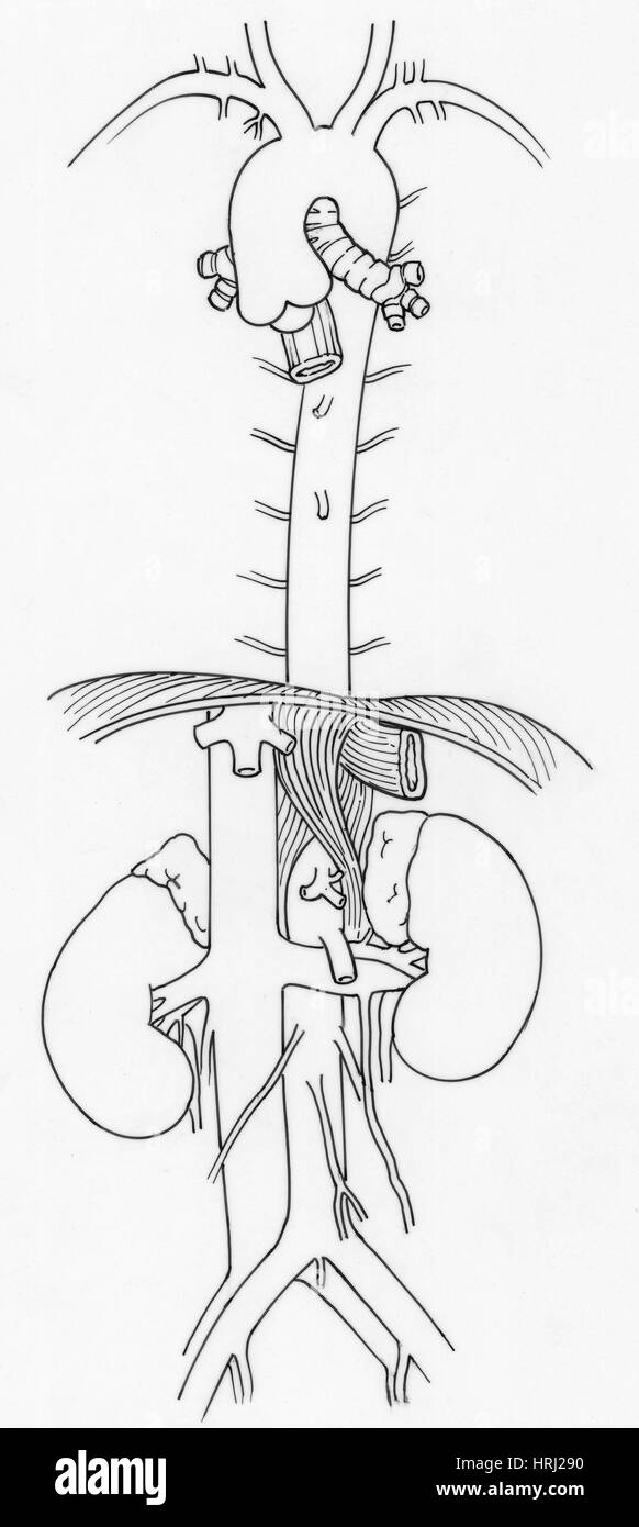 Illustration of Aorta and Branches Stock Photo - Alamy