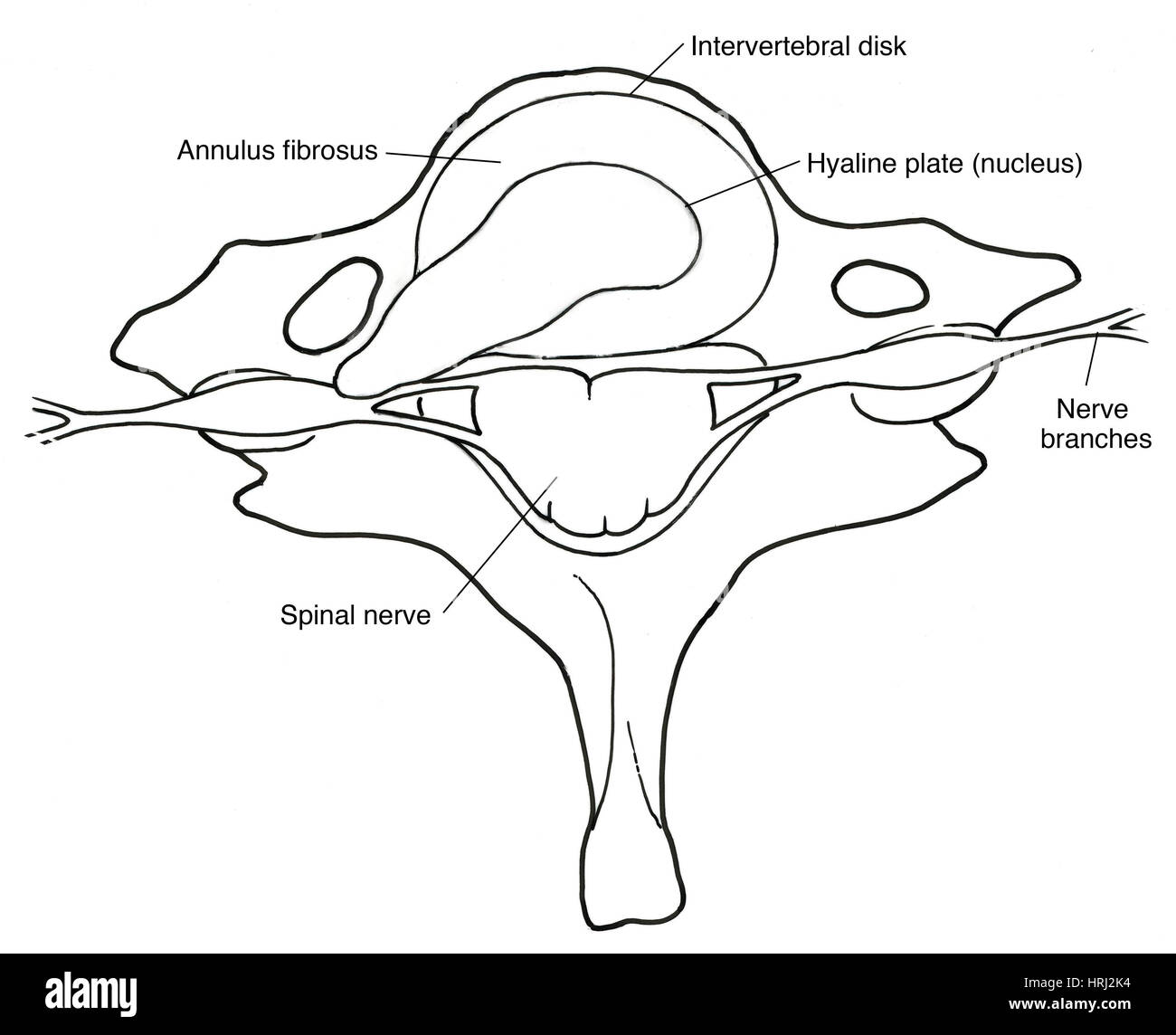 Illustration of Herniated Spinal Disk Stock Photo - Alamy