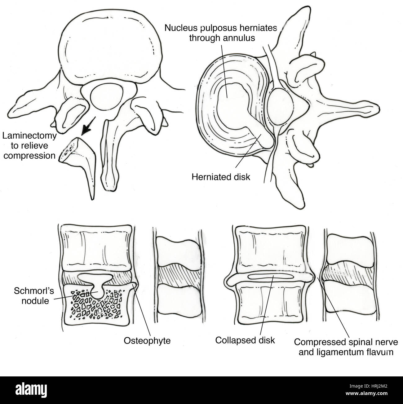 Laminectomy hi-res stock photography and images - Alamy