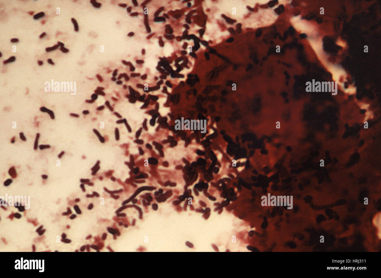 Erythrasma hi-res stock photography and images - Alamy