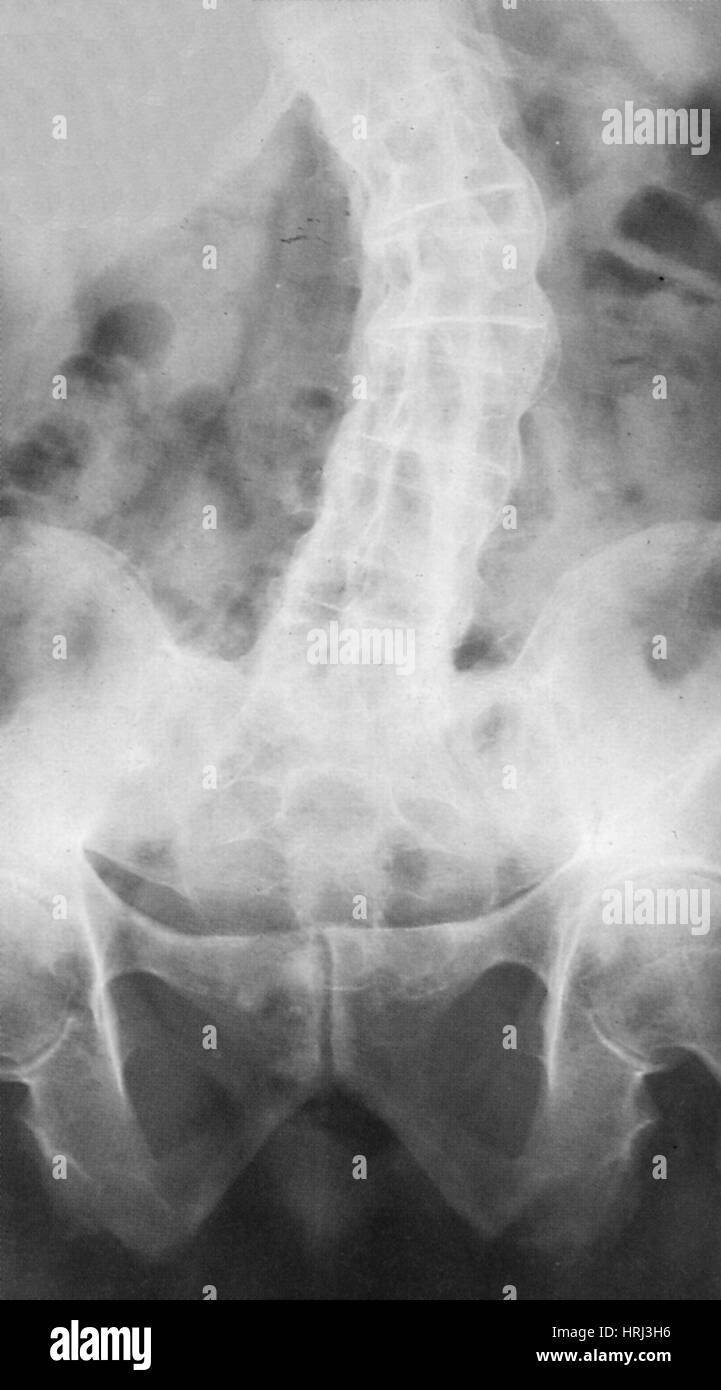 Cervical Ankylosing Spondylitis X Ray