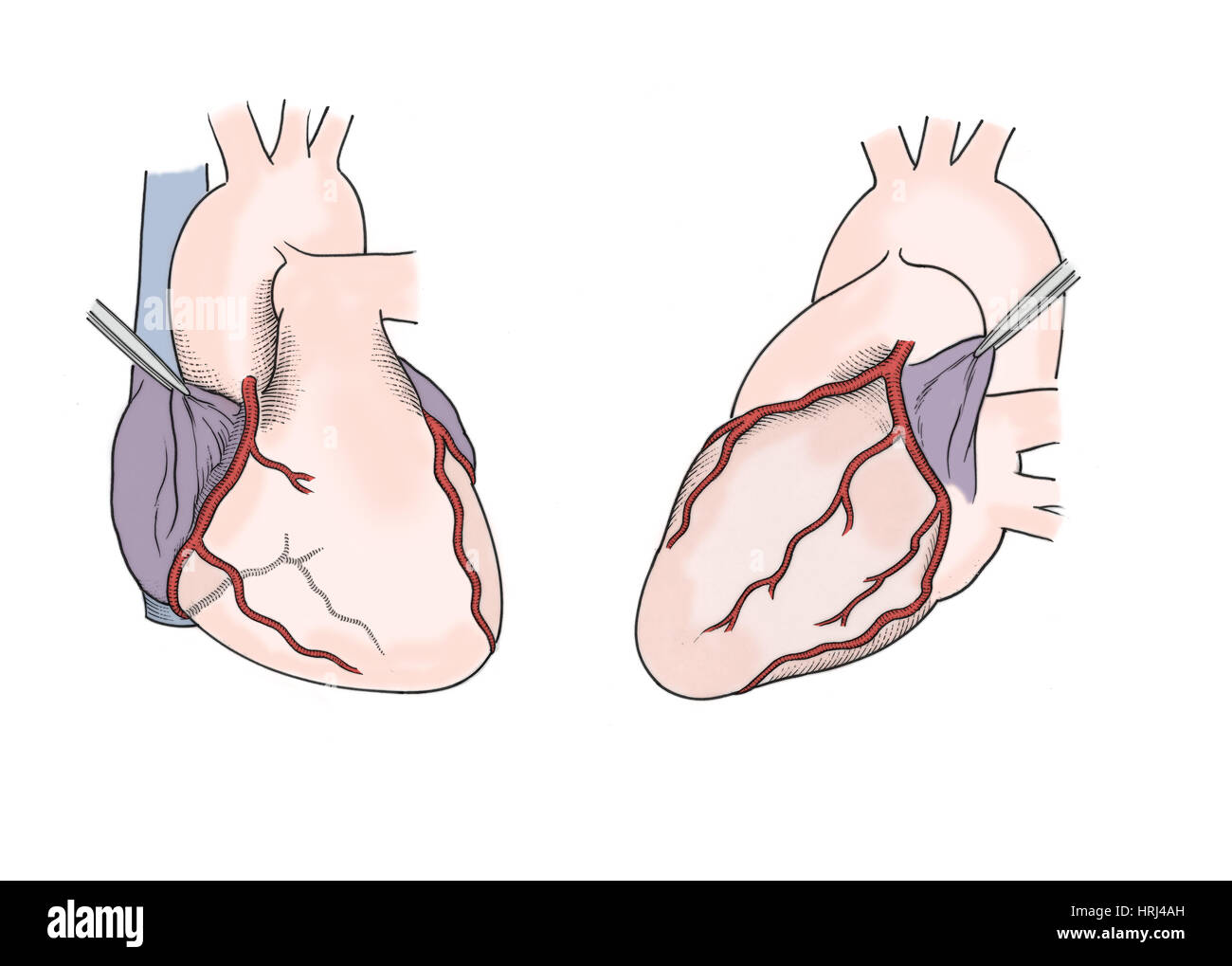 Left circumflex artery hi-res stock photography and images - Alamy