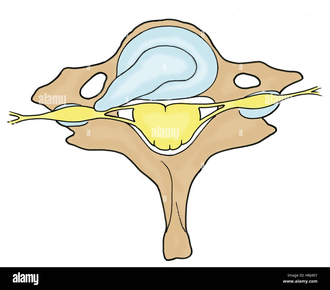 Illustration of Herniated Spinal Disk Stock Photo - Alamy