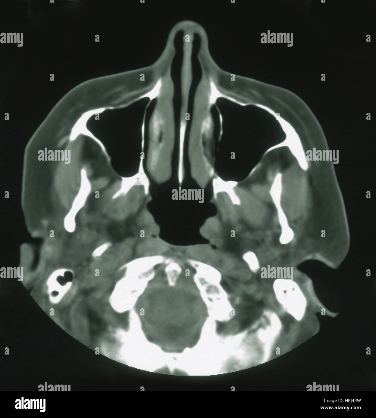 Normal MRI of Sinuses Stock Photo - Alamy
