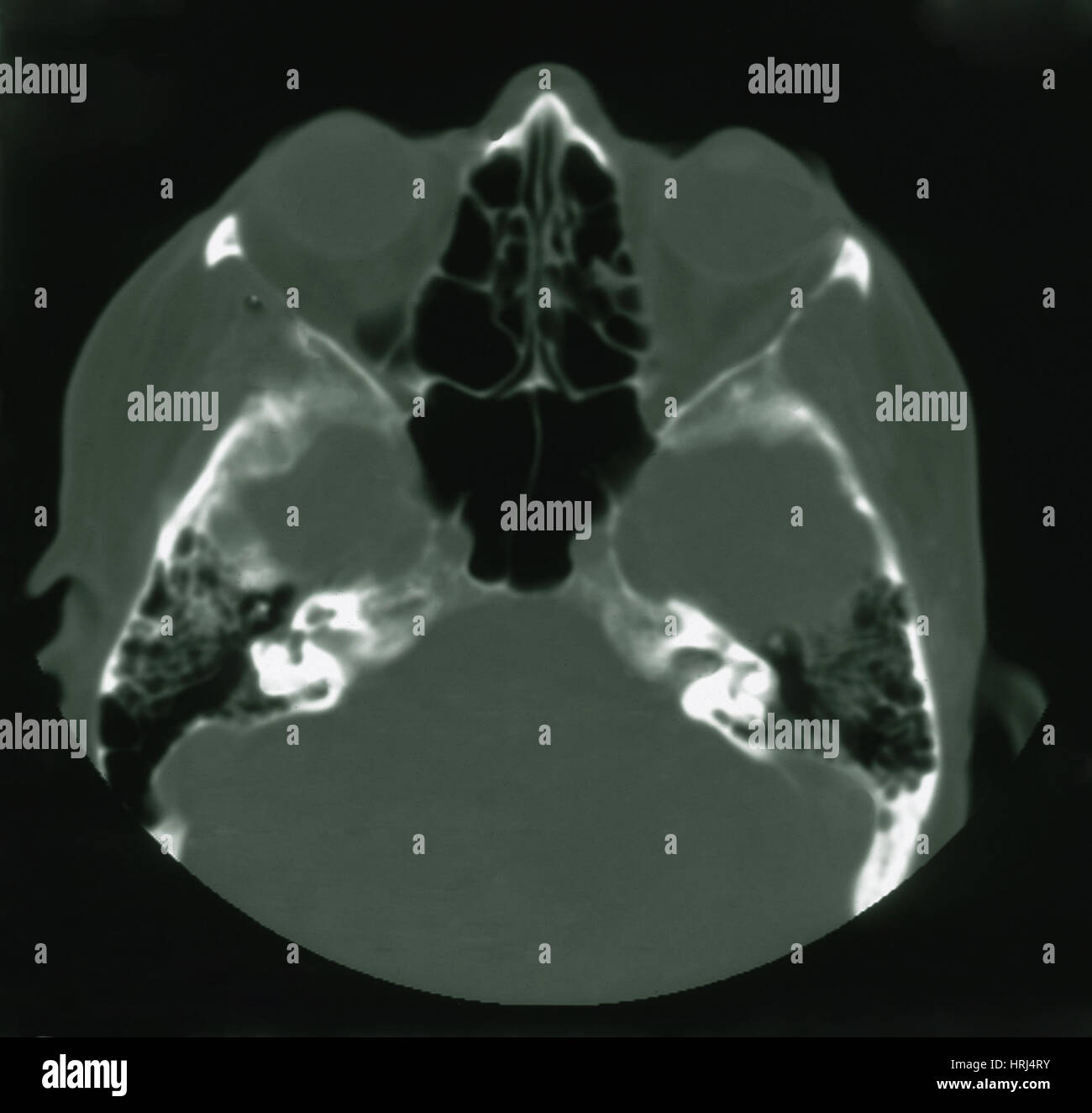 Sinus mri hi-res stock photography and images - Alamy