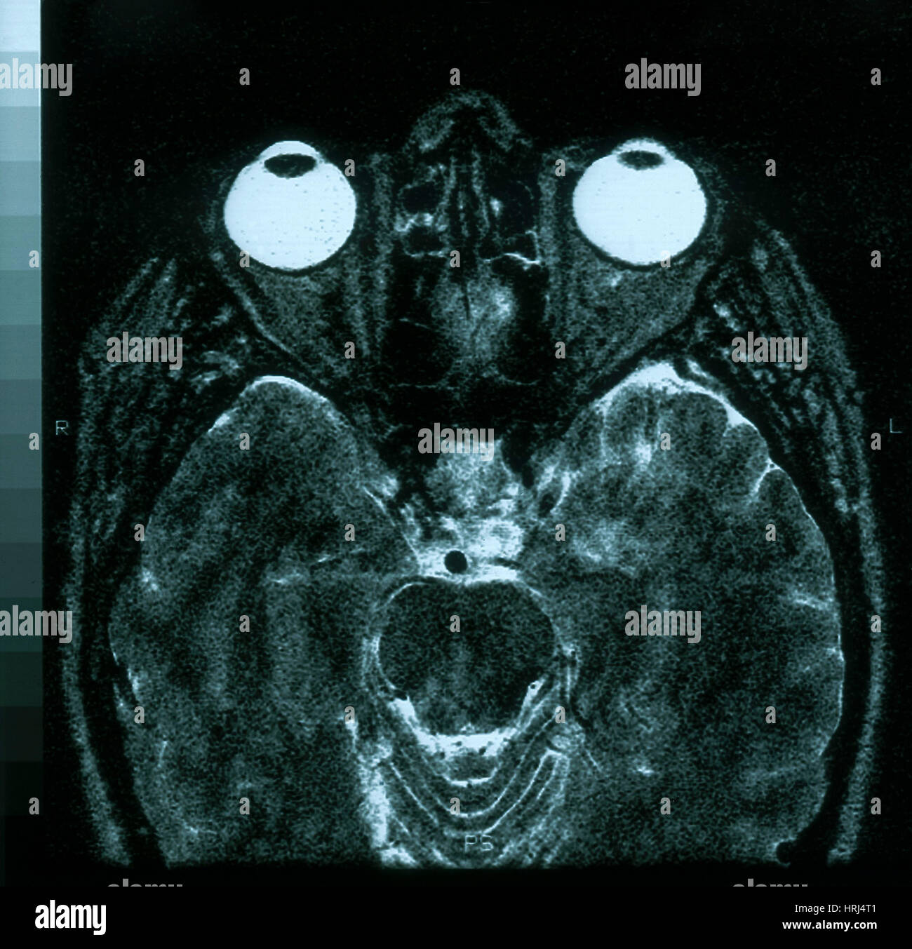 MRI of Normal Brain Stock Photo - Alamy