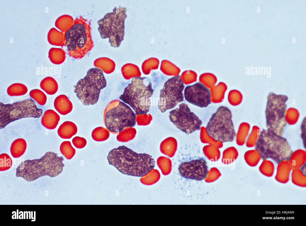Acute leukemia hi-res stock photography and images - Alamy