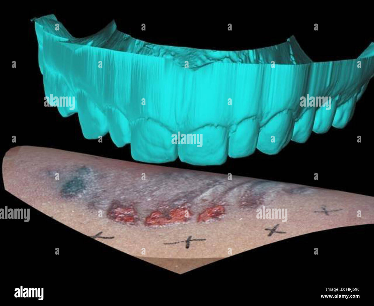 Computer Reconstruction of Bite Mark Stock Photo - Alamy