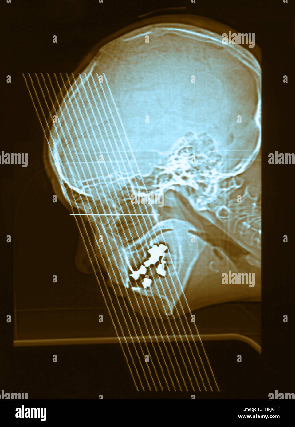 Normal x ray of sinuses hi-res stock photography and images - Alamy