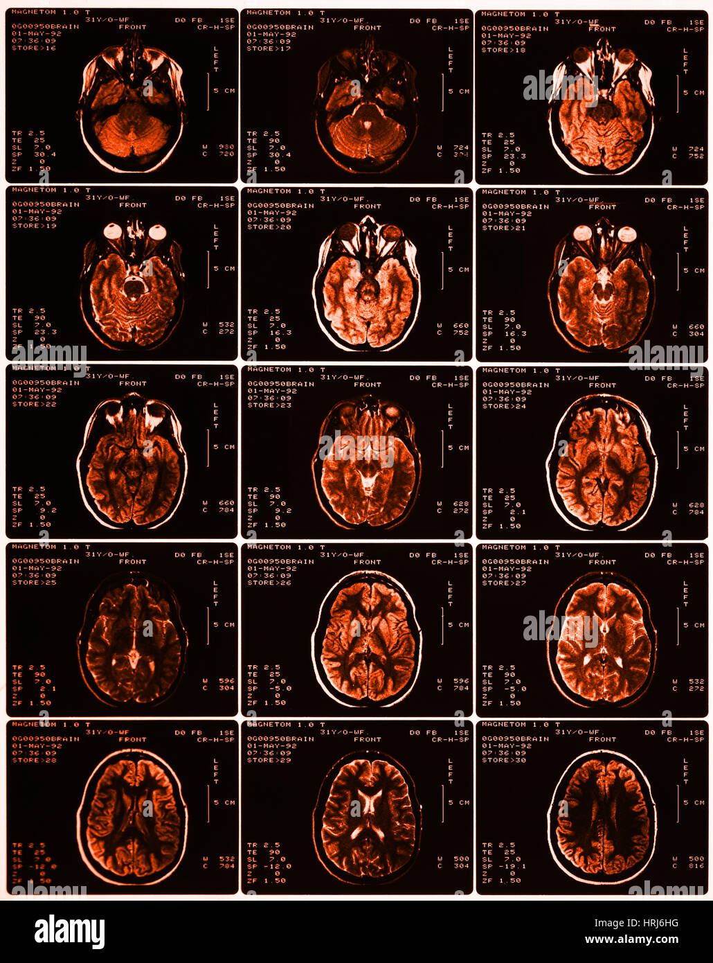 MRI of Normal Brain Stock Photo - Alamy
