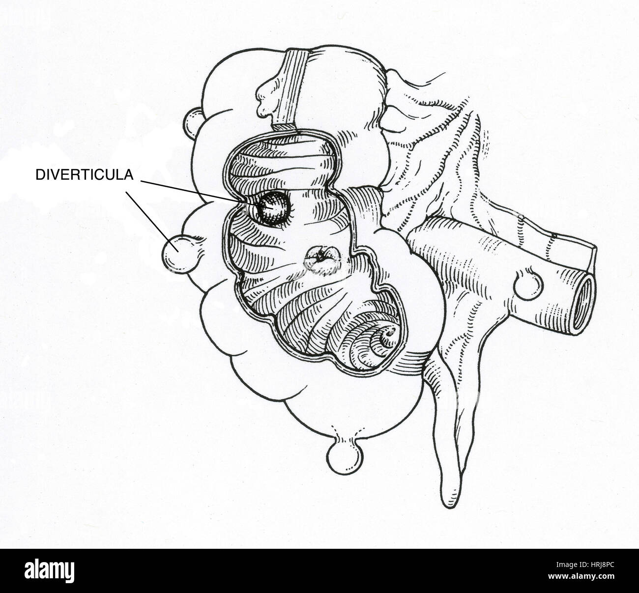 Diverticula hi-res stock photography and images - Alamy