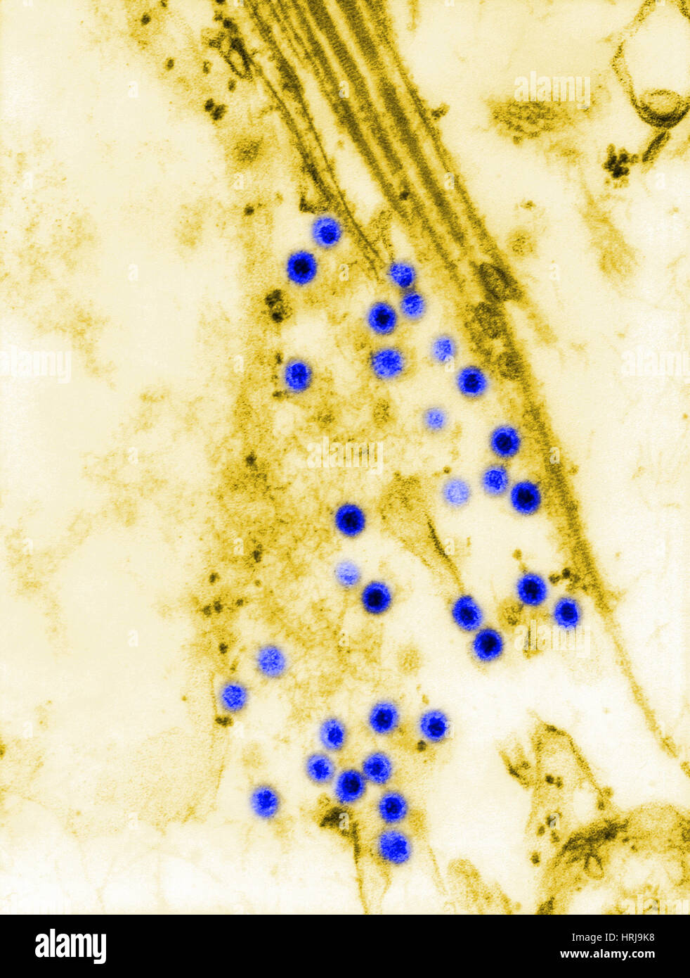 Colorado Tick Fever, TEM Stock Photo - Alamy