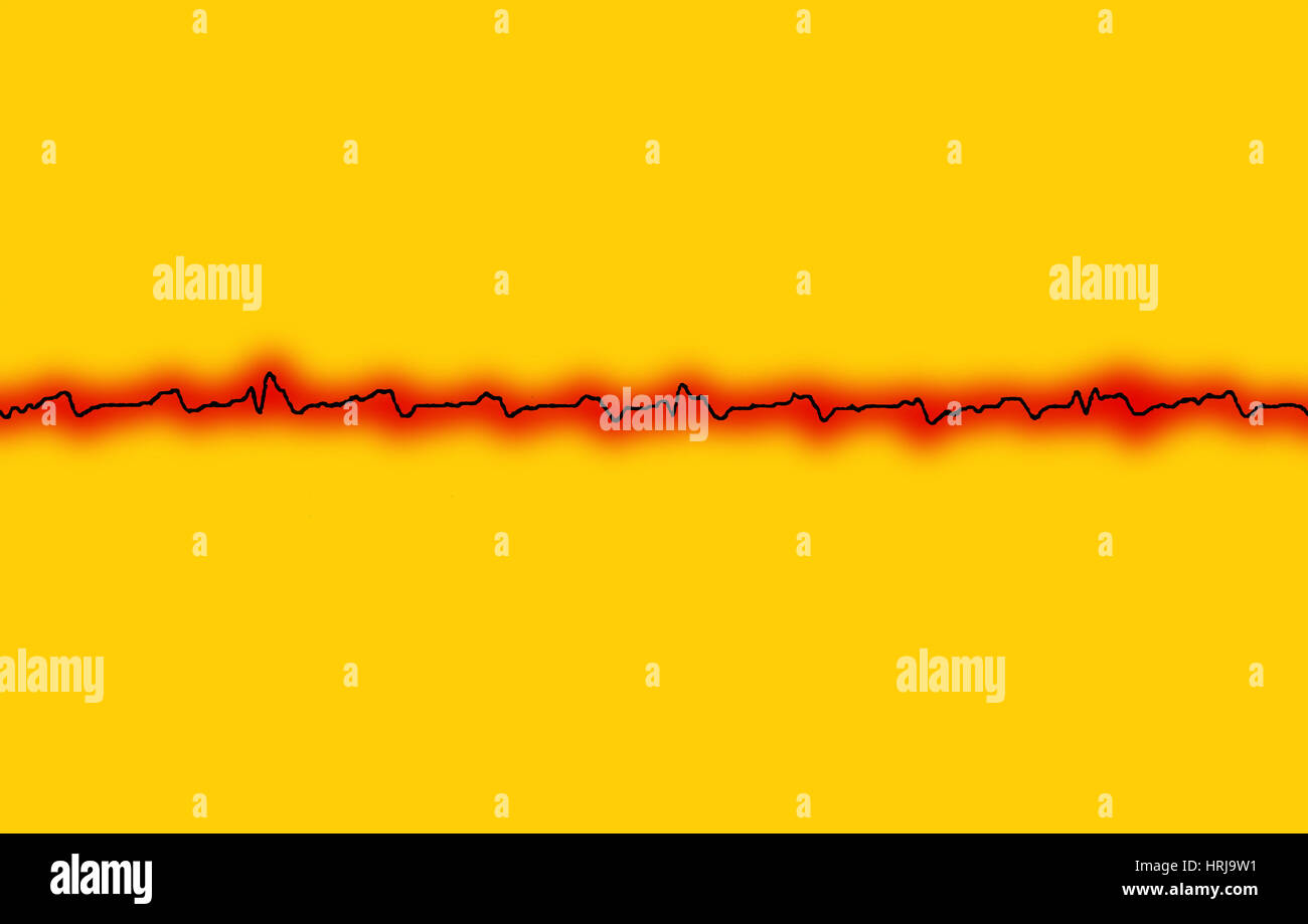 Flutter ecg hi-res stock photography and images - Alamy