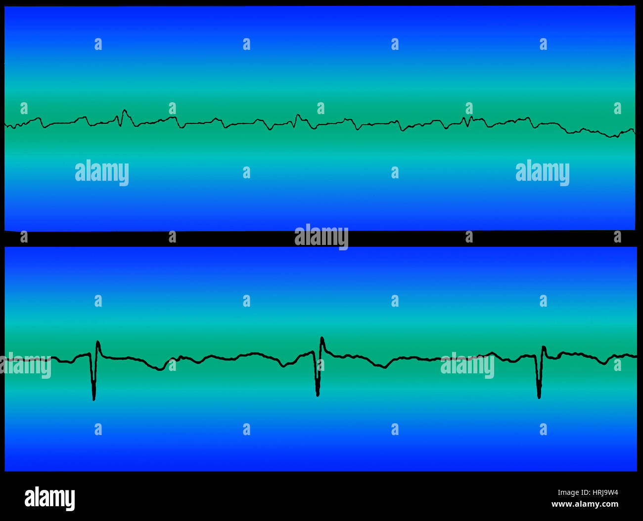 Atrial Flutter & Normal Heart Beat Stock Photo - Alamy