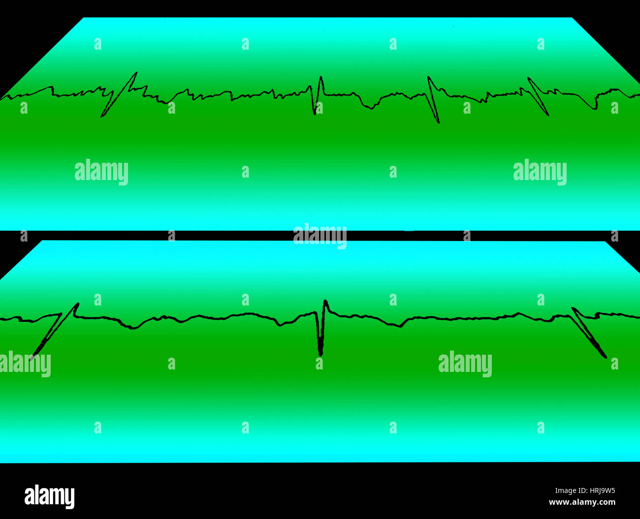 Atrial Flutter & Normal Heart Beat Stock Photo - Alamy