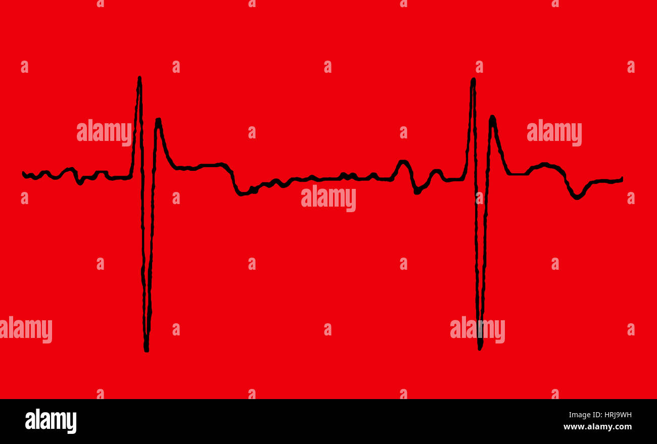 Normal Ecg High Resolution Stock Photography and Images - Alamy