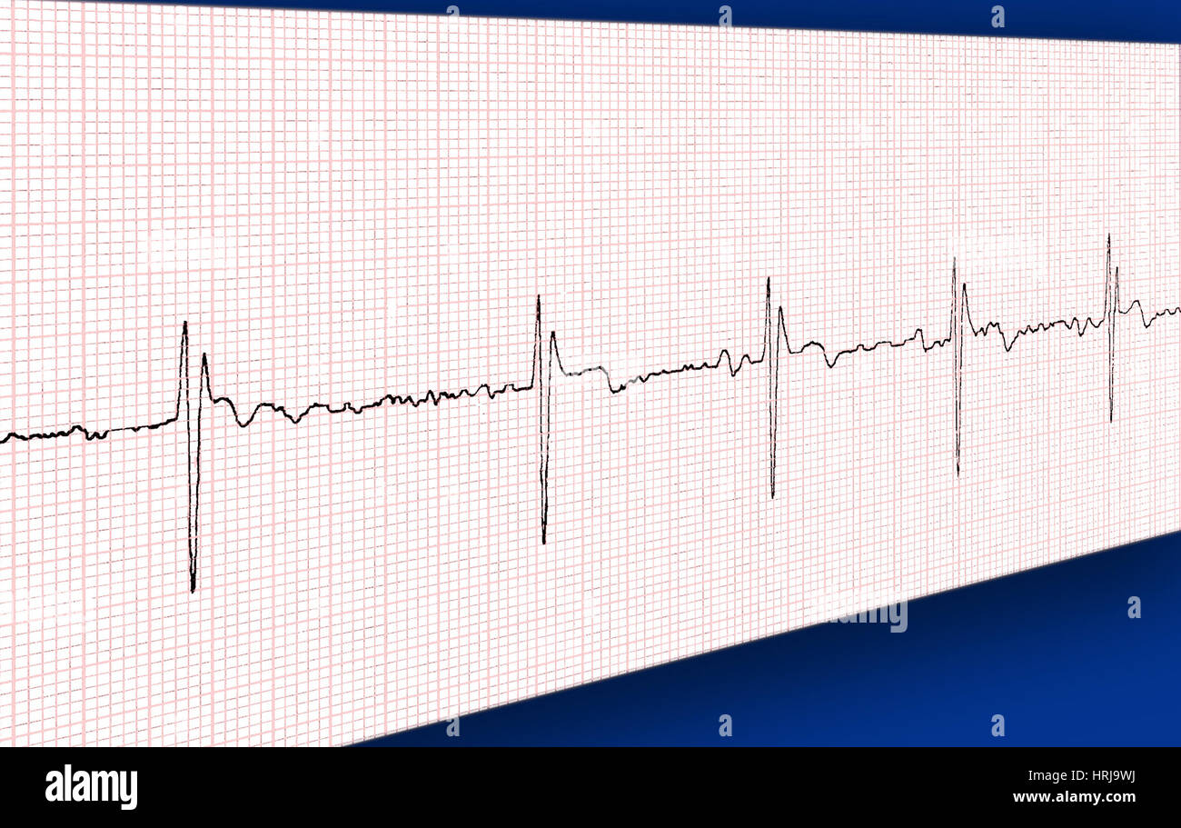 Ecg normal hi-res stock photography and images - Alamy