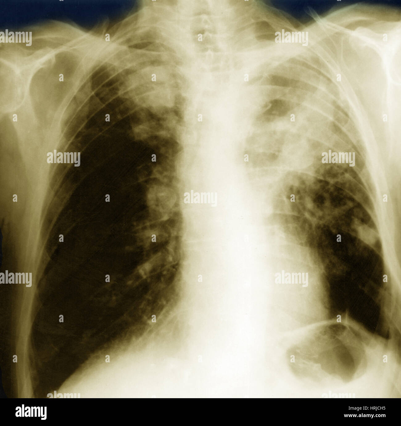 Silicosis x ray hi-res stock photography and images - Alamy